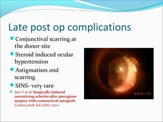 Pterygium Clinical Considerations | PPT