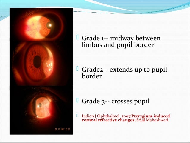 Pterygium Clinical Considerations