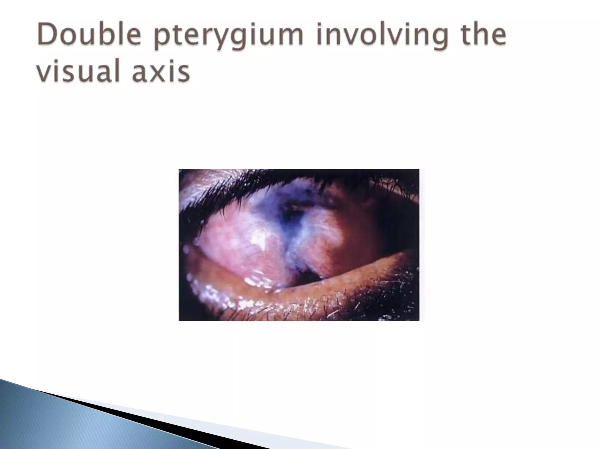 Pterygium and its management | PPTX