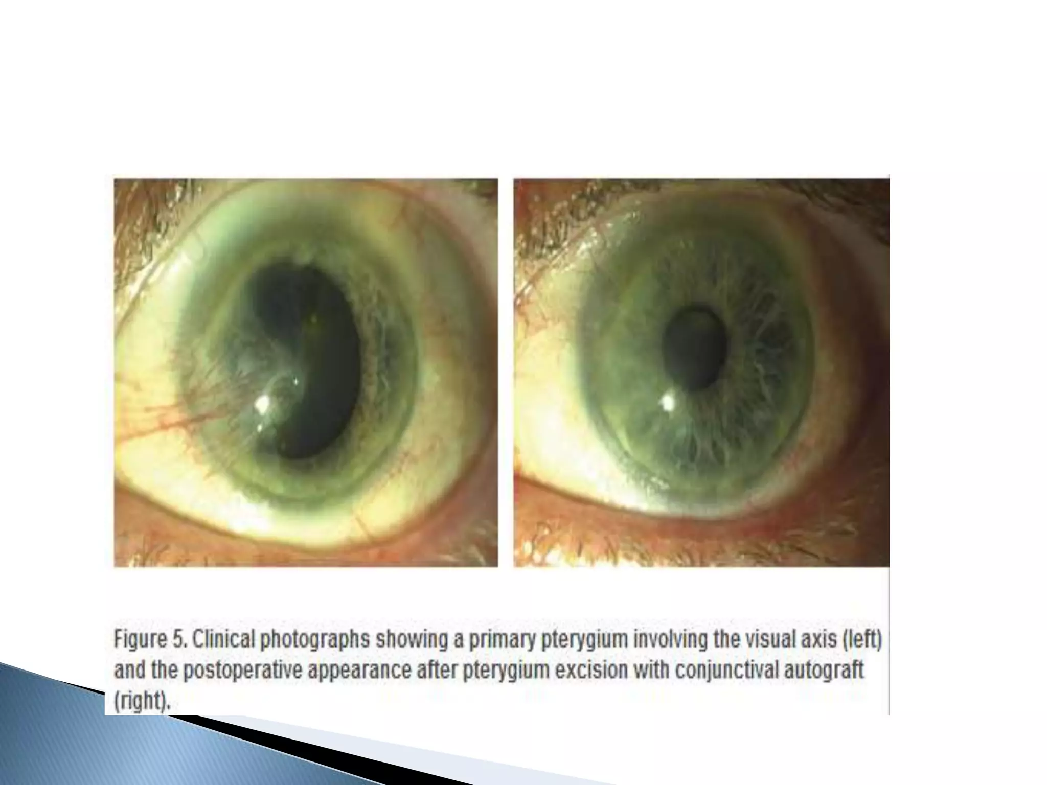 Pterygium and its management | PPTX