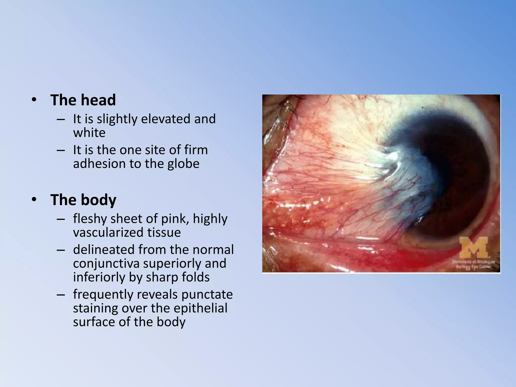 Pterygium and its management | PPTX