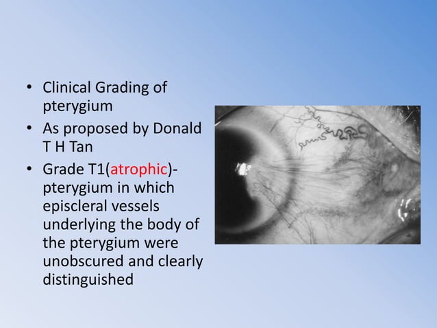 Pterygium and its management | PPTX
