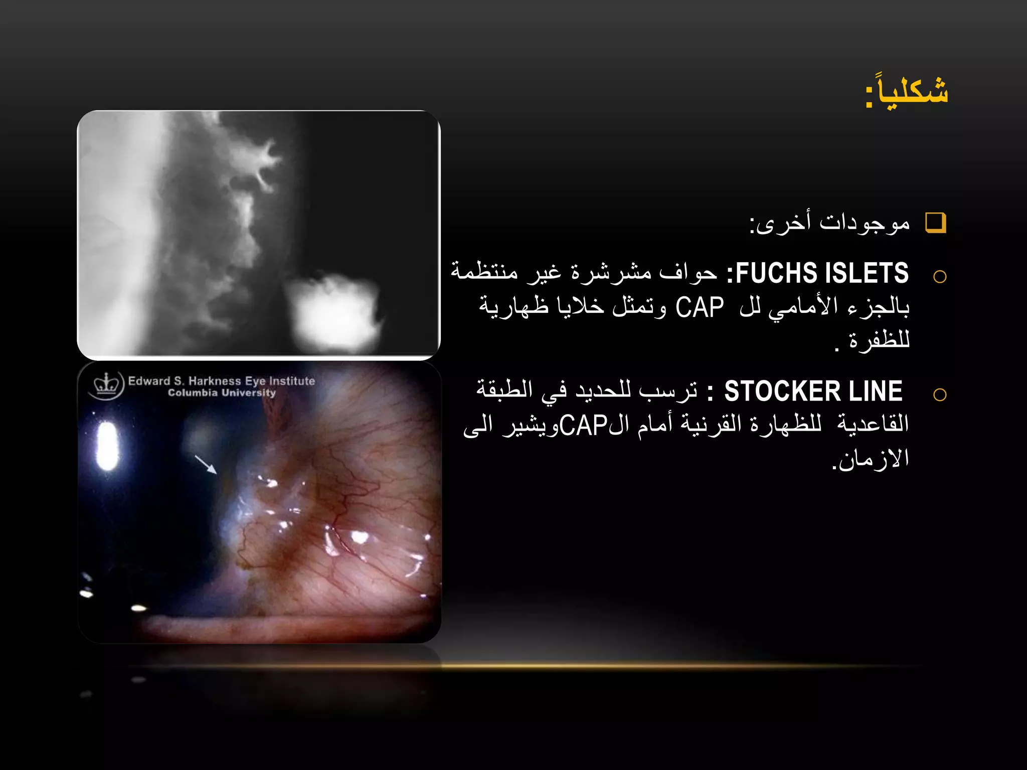 Pterygium (arabic) | PPTX