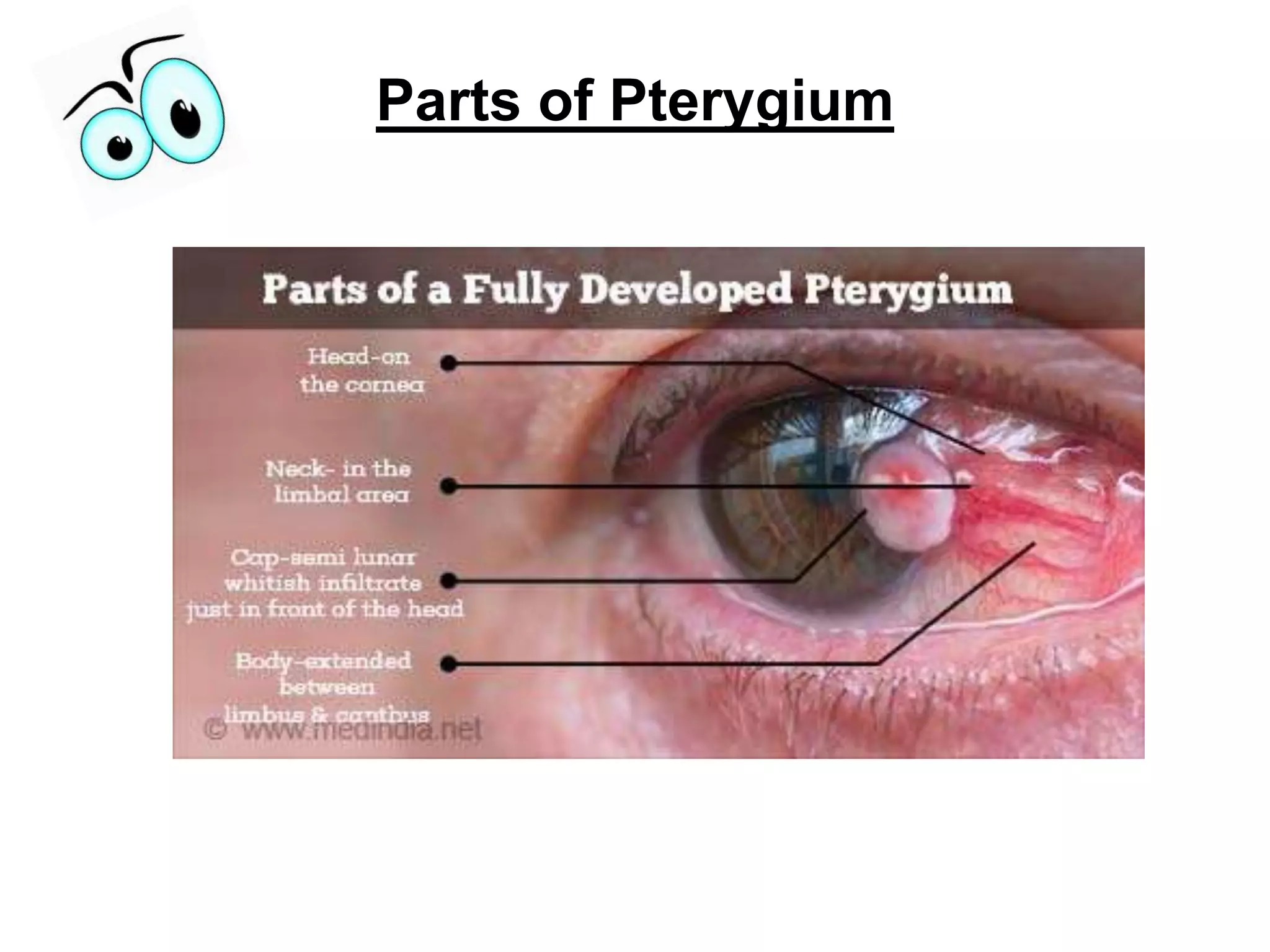 Pterygium (practical slides) | PPTX