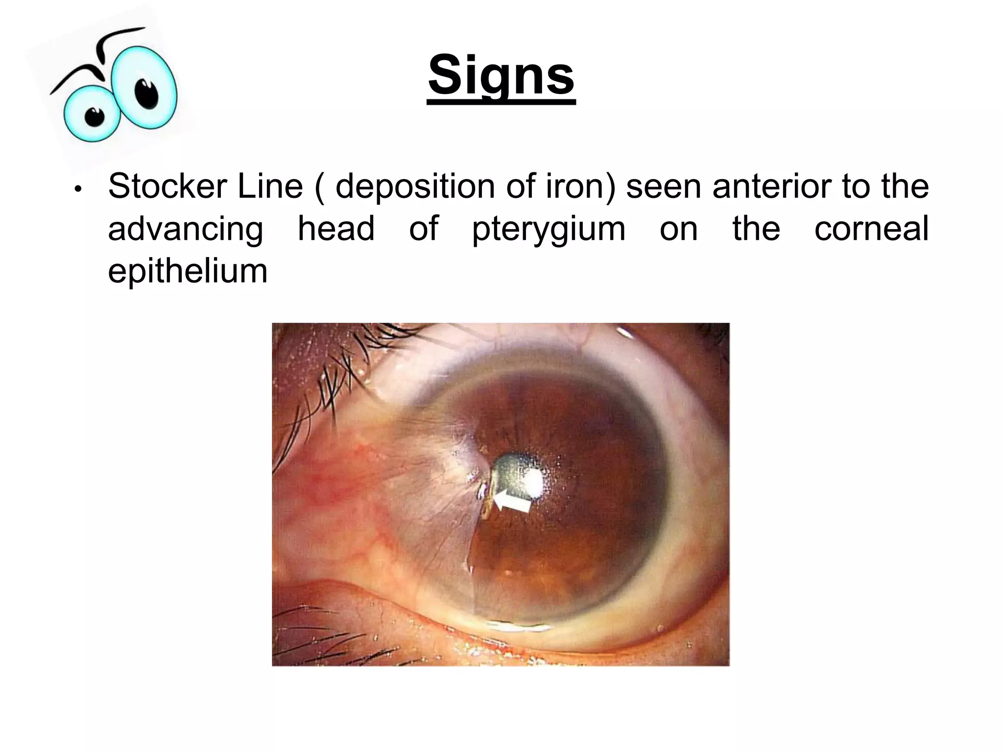 Pterygium (practical slides) | PPTX