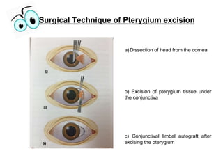 Pterygium (practical slides) | PPTX