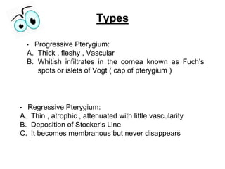 Pterygium (practical slides) | PPTX