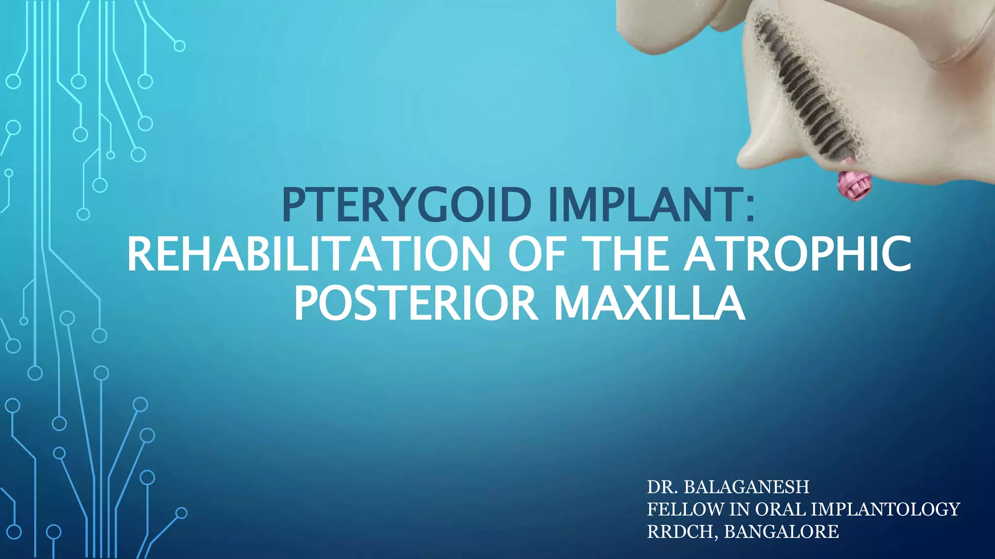 Pterygoid Implants | PPTX