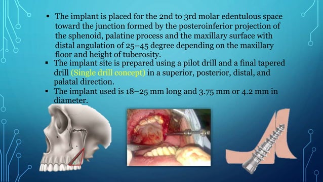 Pterygoid Implants | PPTX | Ear, Nose and Throat Conditions | Diseases ...