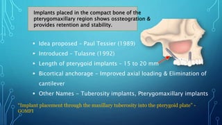 Pterygoid Implants | PPTX