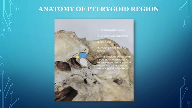 Pterygoid Implants | PPTX | Ear, Nose and Throat Conditions | Diseases ...