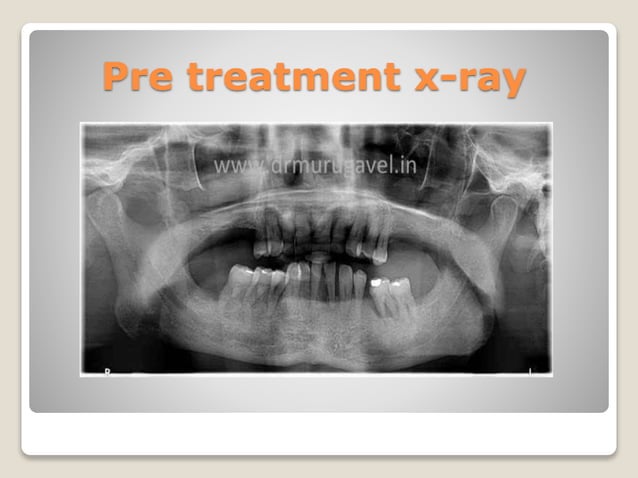 Pterygoid Implants Vs Zygomatic Implants Ppt