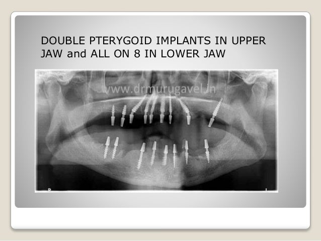 Pterygoid Implants Vs Zygomatic Implants