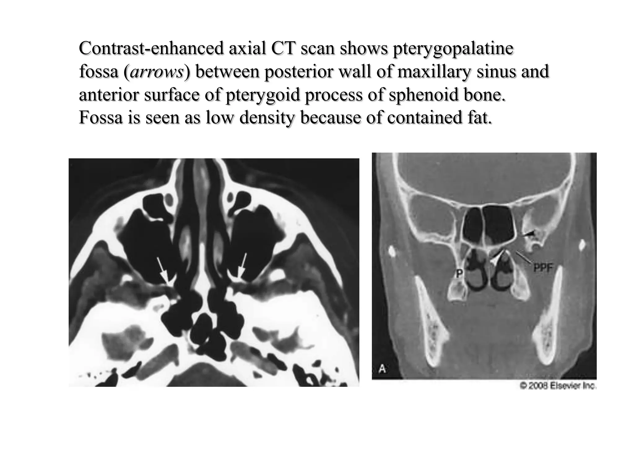 Pterygopalatine fossa and approaches by Dr.Ashwin Menon | PPTX