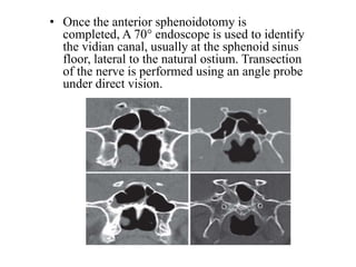 Pterygopalatine fossa and approaches by Dr.Ashwin Menon | PPTX