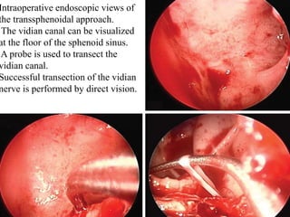 Pterygopalatine fossa and approaches by Dr.Ashwin Menon | PPTX