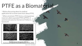 PTFE - Poly Tetra fluro Ethylene (Teflon) Medical uses | Biomedical ...