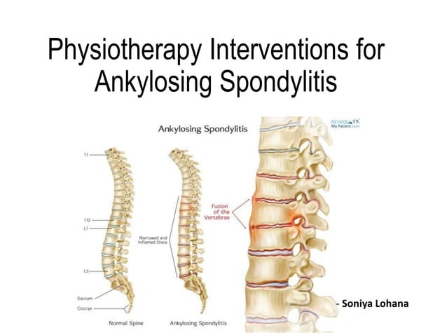 PT for Ankylosing Spondylitis | PPTX | Physical Therapy | Wellness