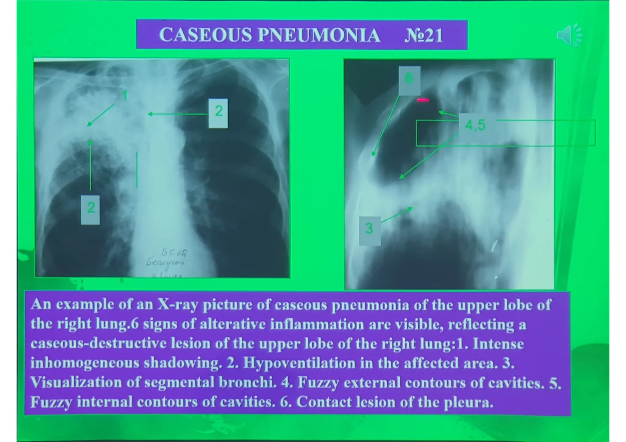 Acute progressive tuberculosis. Tuberculosis | PDF