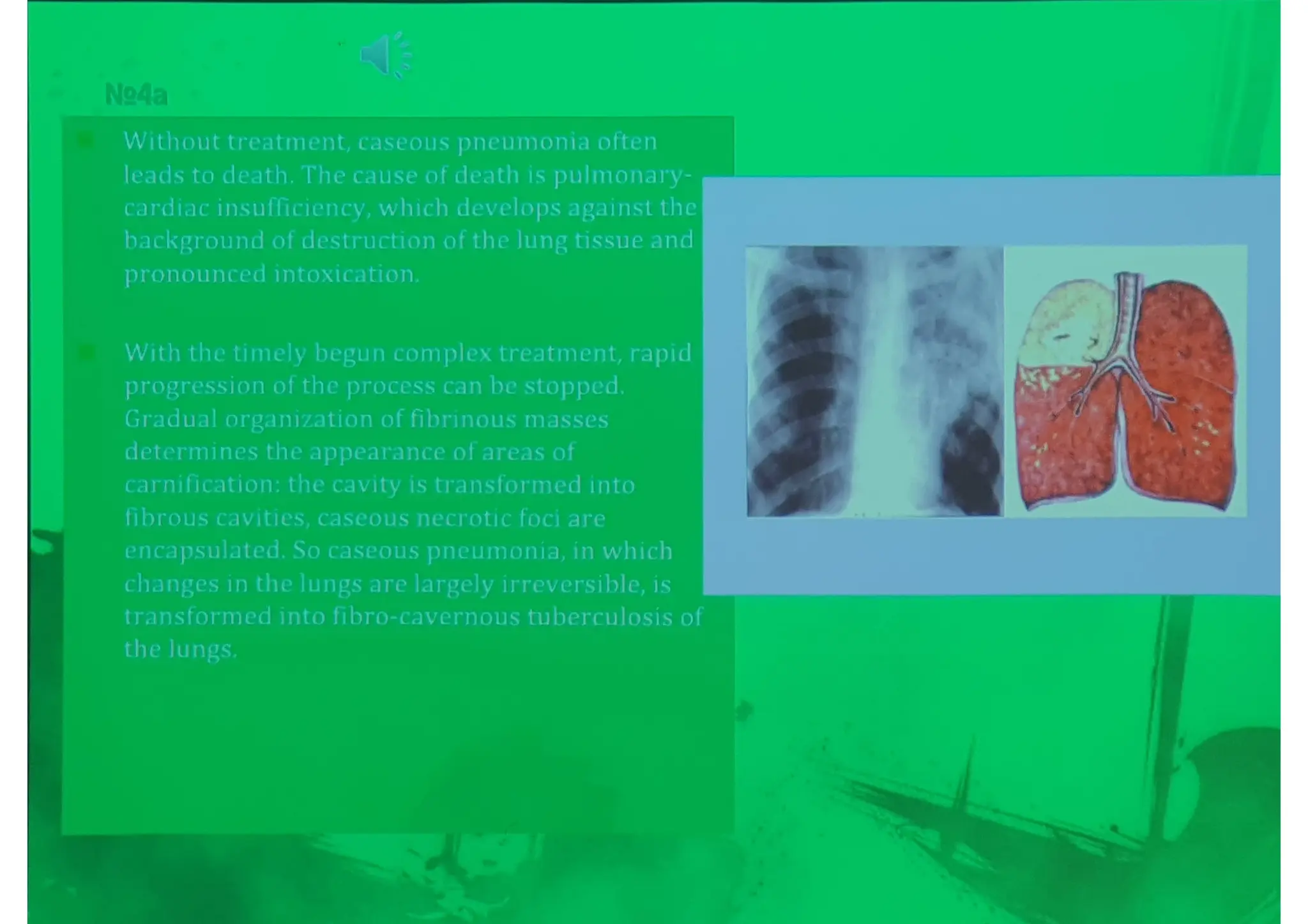 Acute progressive tuberculosis. Tuberculosis | PDF