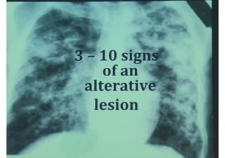 Acute progressive tuberculosis. Tuberculosis | PPT