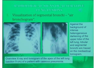 Acute progressive tuberculosis. Tuberculosis | PPT