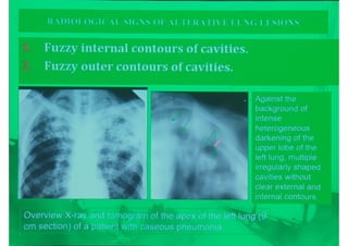 Acute progressive tuberculosis. Tuberculosis | PPT