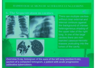 Acute progressive tuberculosis. Tuberculosis | PPT