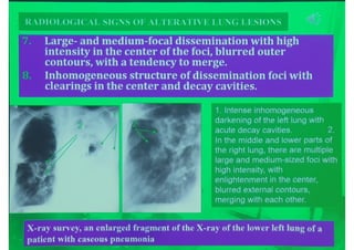 Acute progressive tuberculosis. Tuberculosis | PPT