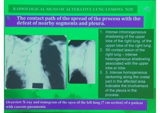 Acute progressive tuberculosis. Tuberculosis | PPT
