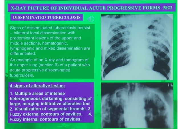 Acute progressive tuberculosis. Tuberculosis | PPT