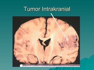 Peningkatan Tekanan Intrakranial | PPT