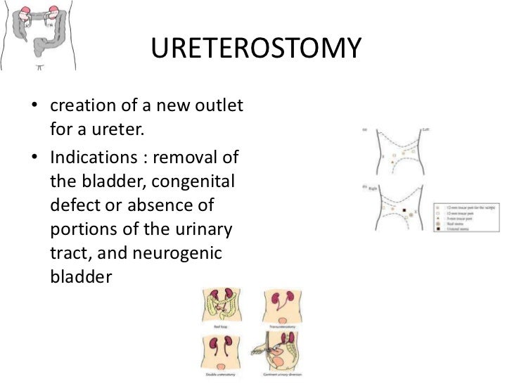 Pt in urosurgery