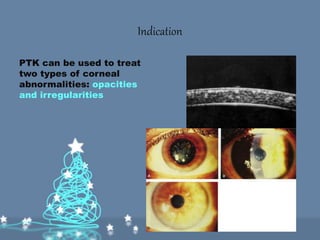 Excimer Laser Phototheraputic Keratectomy ( PTK ) | PPTX