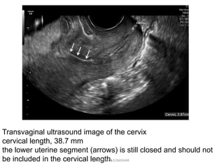 Cervical length for preterm birth prevention Aboubakr ELNASHAR | PPSX