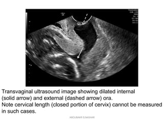 Dilated Cervix Ultrasound