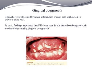 PATHOLOGIC TOOTH MIGRATION .pptx