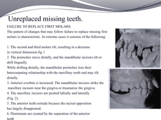 PATHOLOGIC TOOTH MIGRATION .pptx