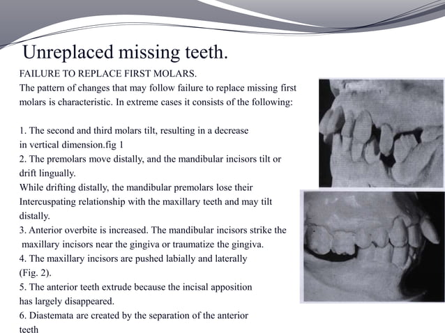 PATHOLOGIC TOOTH MIGRATION .pptx