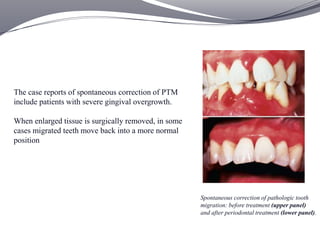 PATHOLOGIC TOOTH MIGRATION .pptx