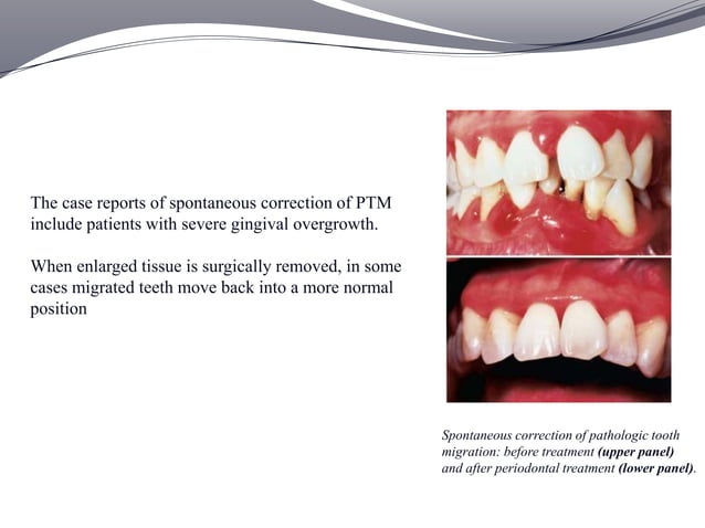 PATHOLOGIC TOOTH MIGRATION .pptx
