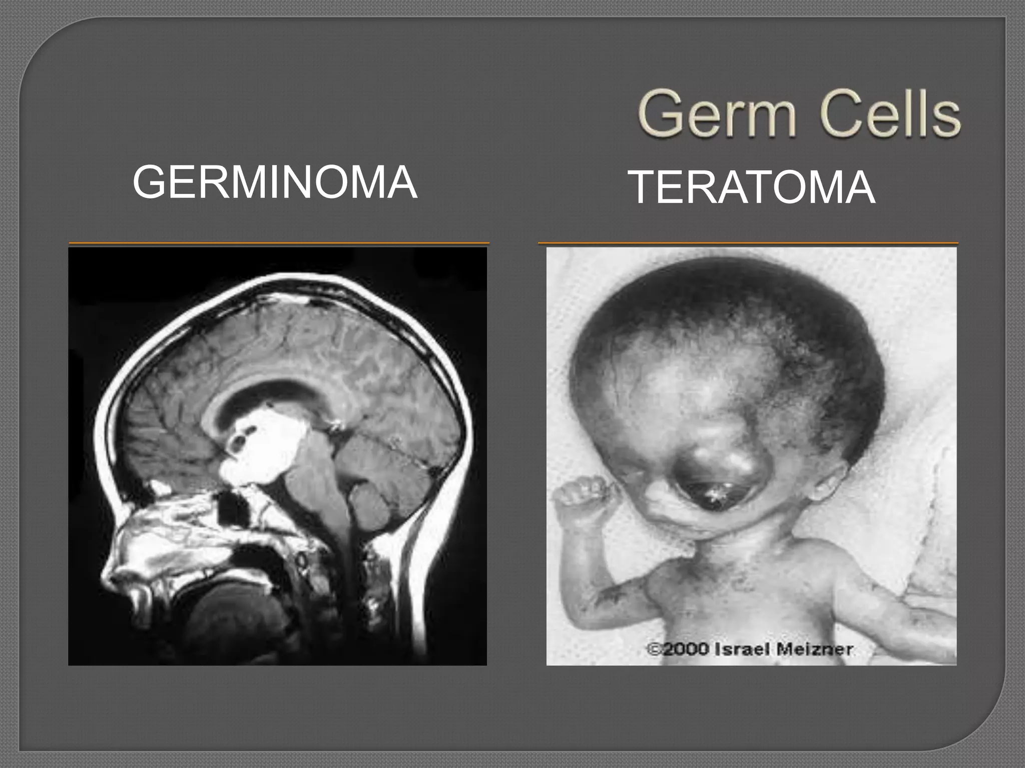 Physiotherapy management of brain tumors and neurocutaneous disorders ...