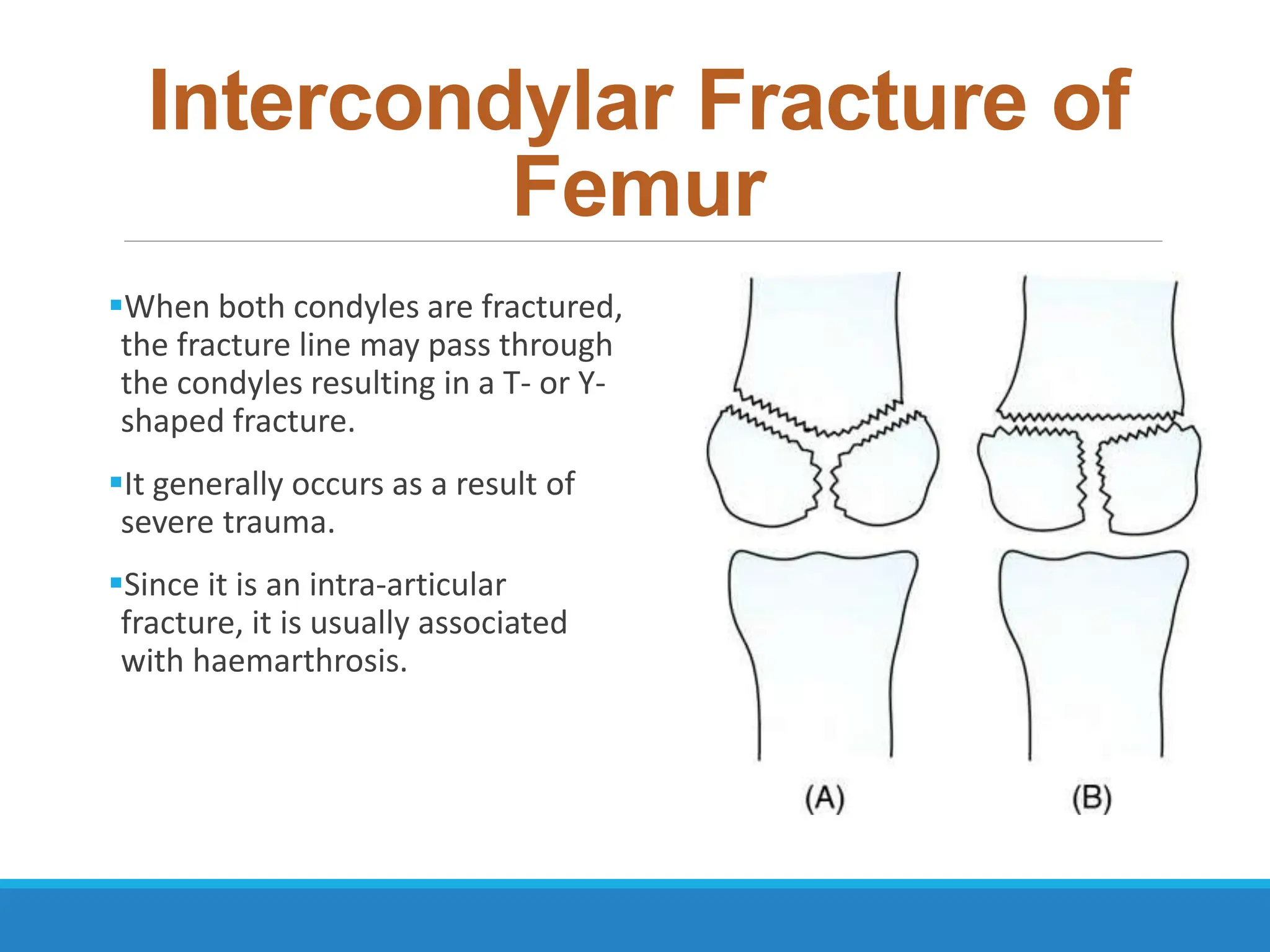PT Management of Fractures of Condyles of Femur | PPTX