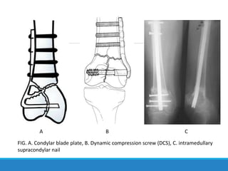PT Management of Fractures of Condyles of Femur | PPTX