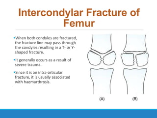 PT Management of Fractures of Condyles of Femur | PPTX