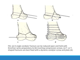PT Management of Fractures of Condyles of Femur | PPTX