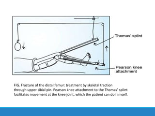 PT Management of Fractures of Condyles of Femur | PPTX