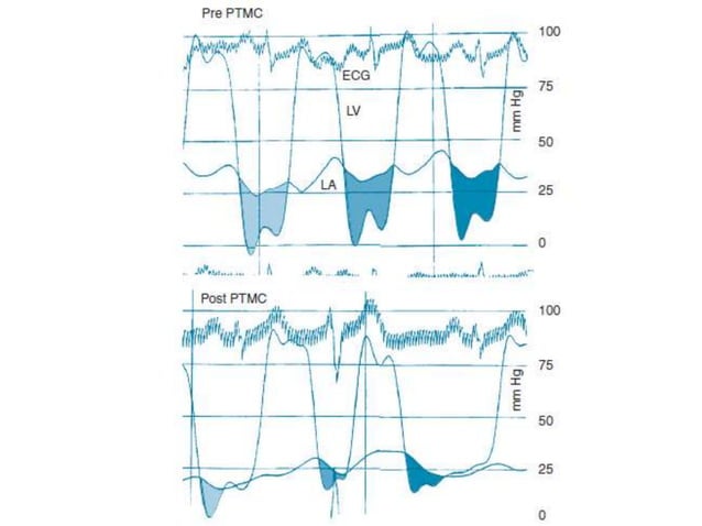 PTMC/PBMC | PPTX