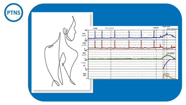 PTNS Percutaneous Tibial Nerve Stimulation | PPTX