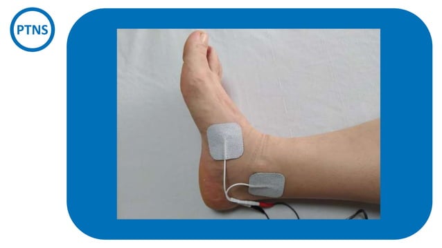 PTNS Percutaneous Tibial Nerve Stimulation | PPTX